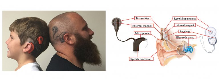Cochlear Implant Magnets - SDM Magnetics Co., Ltd.